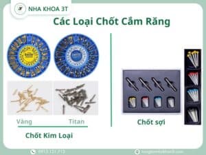 Cắm Chốt Răng Là Gì & Khi Nào Cần Cắm Chốt Răng?