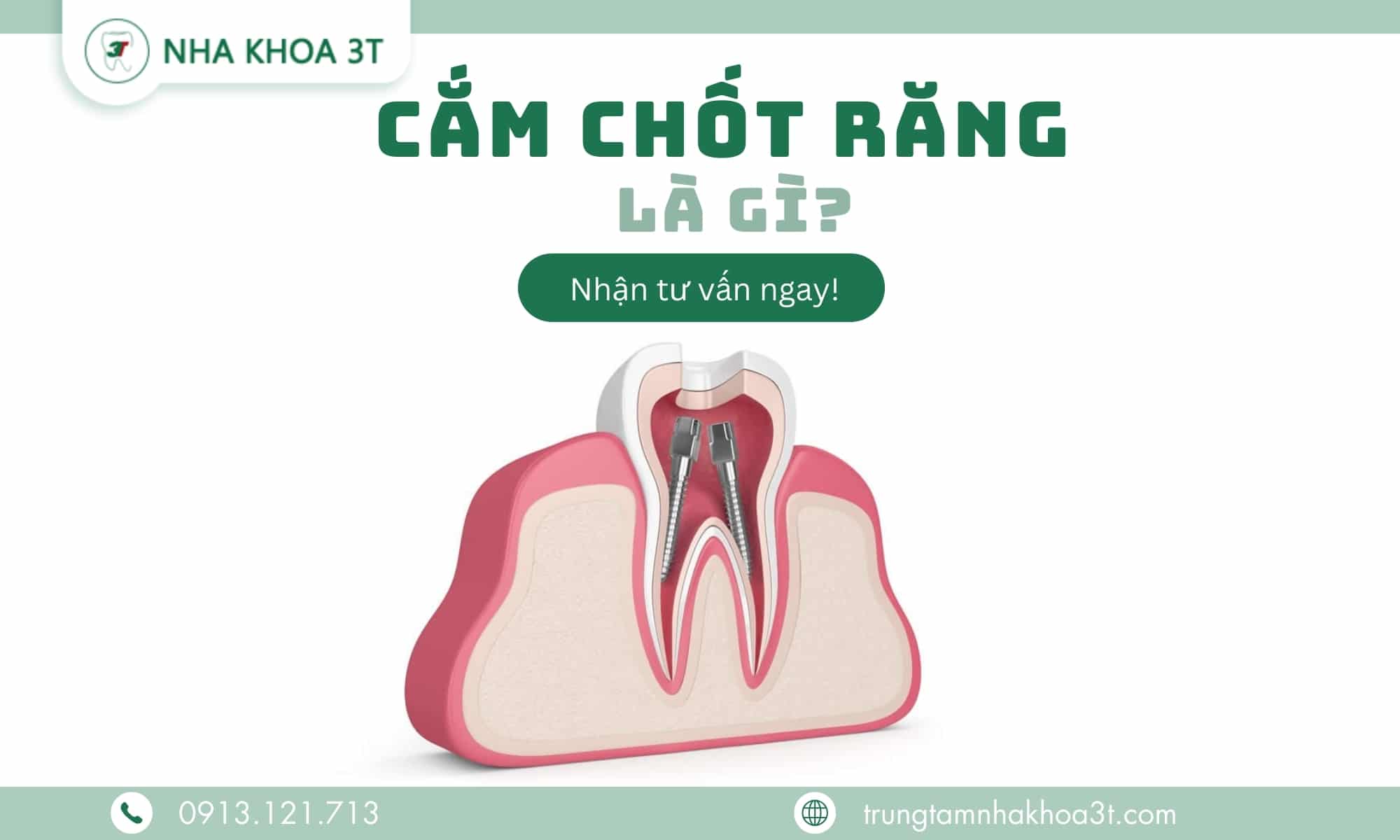 Cắm Chốt Răng, Giải Pháp Phục Hồi Răng Hư Tổn