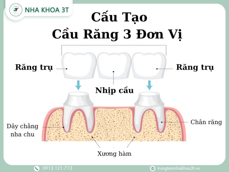 Bắt Cầu Răng Sứ Là Gì & Ưu Điểm Của Cầu Răng Sứ