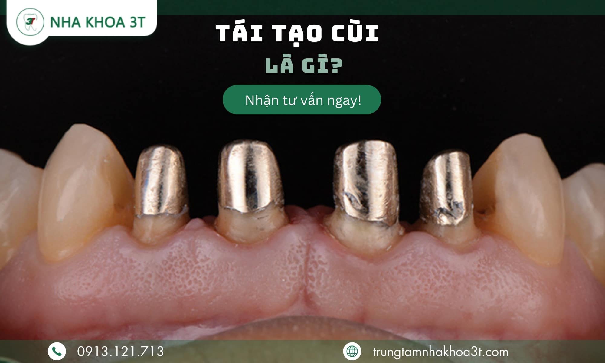 Phương Pháp Tái Tạo Cùi, Phục Hồi Răng Hư Tổn