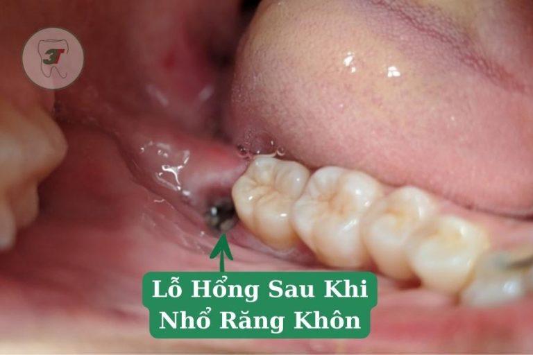 Lỗ Hổng Sau Khi Nhổ Răng Khôn Có Hết Không?