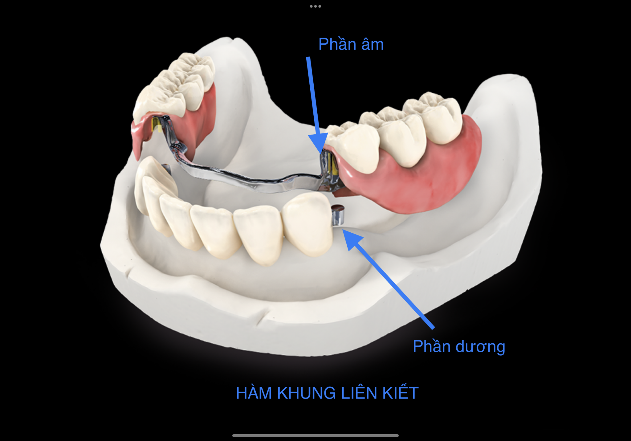 Hàm Khung Liên Kết Attachment Là Gì?